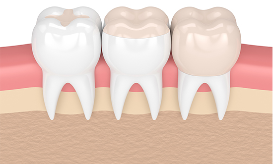 How do you make a crown/onlay?