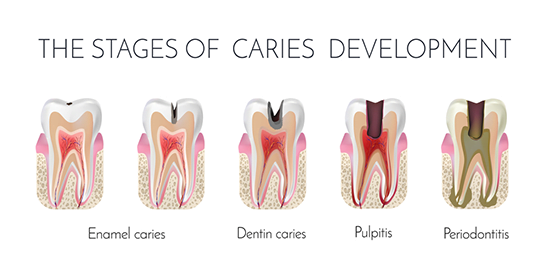 Root Canal Treatment Sensational Smiles